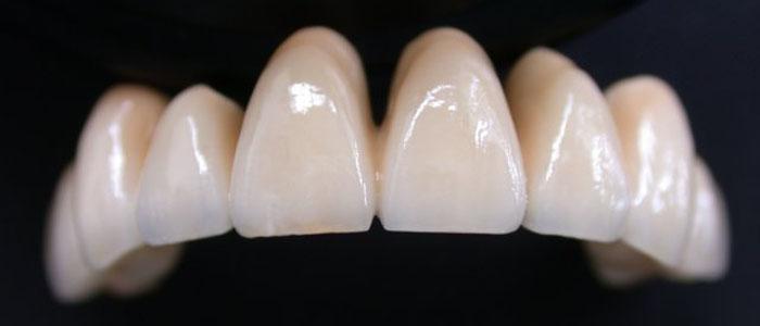 Fogsorkészítés Óbuda, fogtechnika 3. kerület